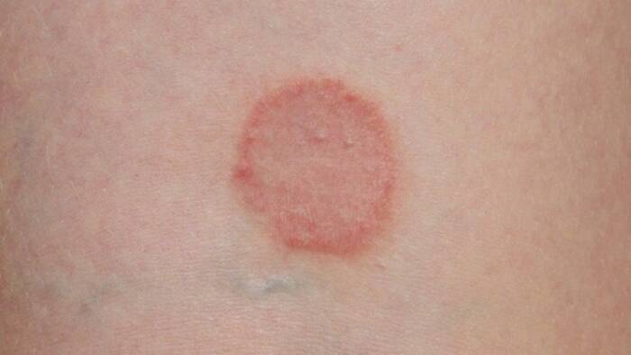 Apa Itu Tinea Cruris? Inilah Penyebab, Gejala, dan Pengobatannya - Kwikku